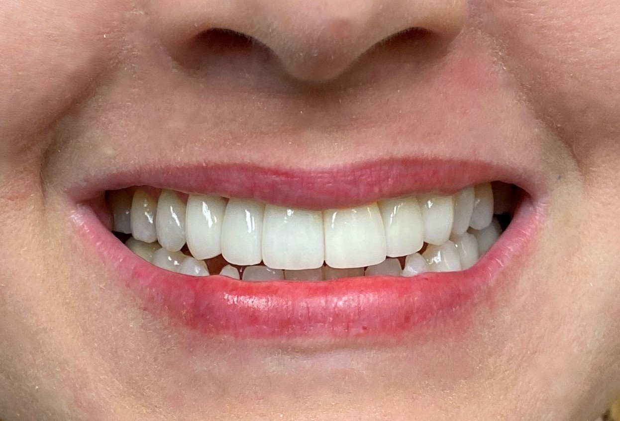 Smile Gallery - HiTec Dental Ceramics
