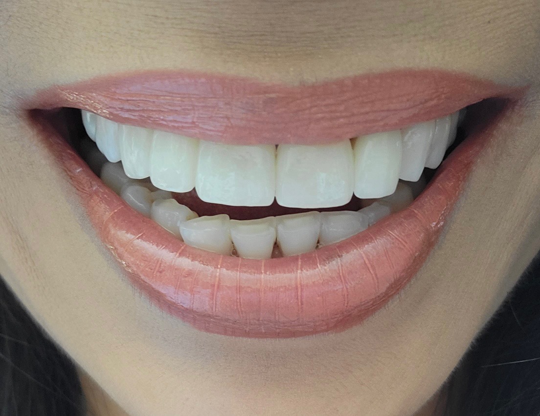 Smile Gallery - HiTec Dental Ceramics