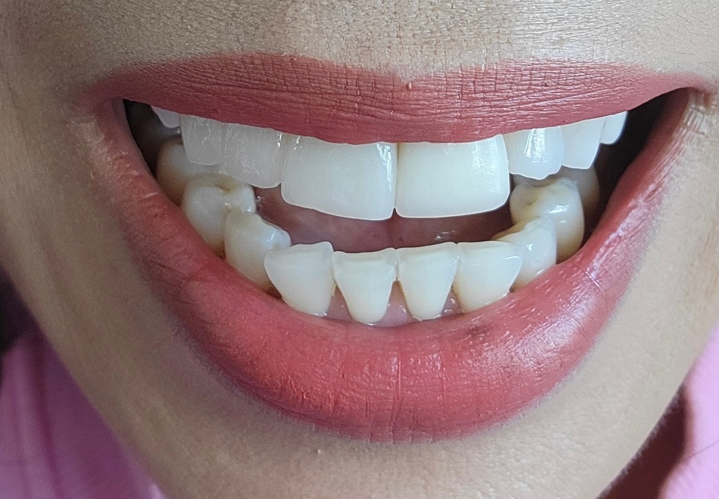 Smile Gallery - HiTec Dental Ceramics